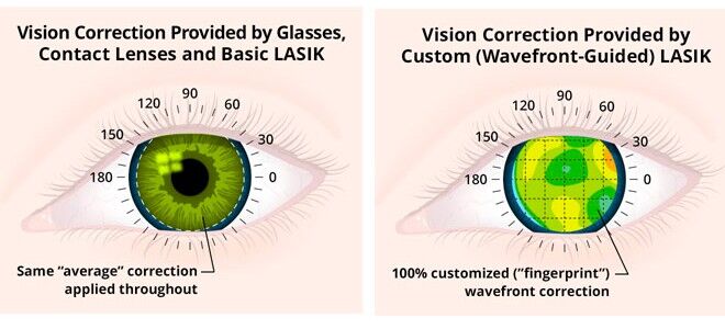 What Is LASIK Eye Surgery Is It Right For You